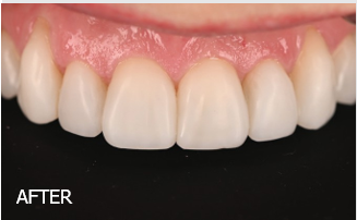 From Worn to Refined: Injectable Composite Veneers with Luna Flow ...