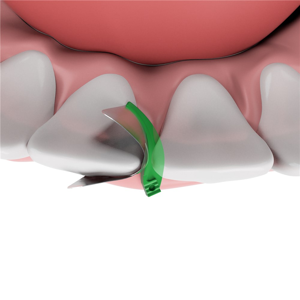 Garrison Fusion Anterior Matrix System Kit | Bands - Henry Schein ...