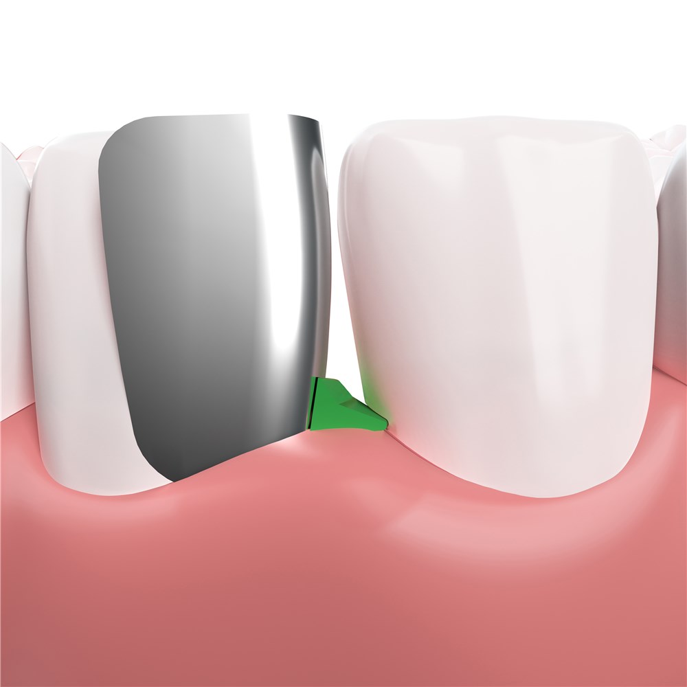 Garrison Fusion Anterior Matrix System Kit | Bands - Henry Schein ...
