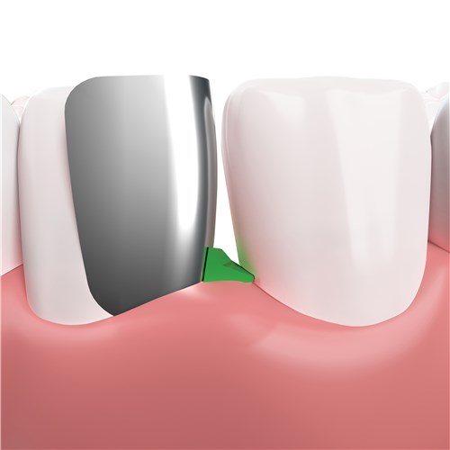 Garrison Fusion Anterior Matrix System Kit | Bands - Henry Schein ...