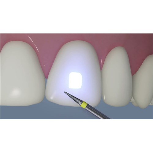 Voco AlignerFlow LC - Fluorescent Composite for Aligner Attachments ...