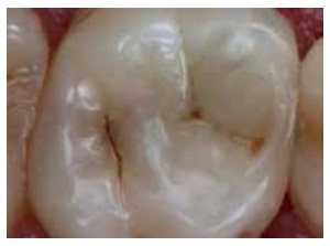 Effective Solution For A Defective Amalgam Restoration - Henry Schein ...