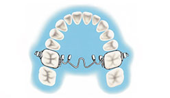 Orthodontics - Henry Schein Australian dental products, supplies and ...