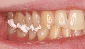 Impression - Henry Schein Australian dental products, supplies and ...