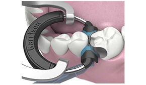 Matrix Bands & Retainers - Restorative & Cosmetic - Henry Schein ...