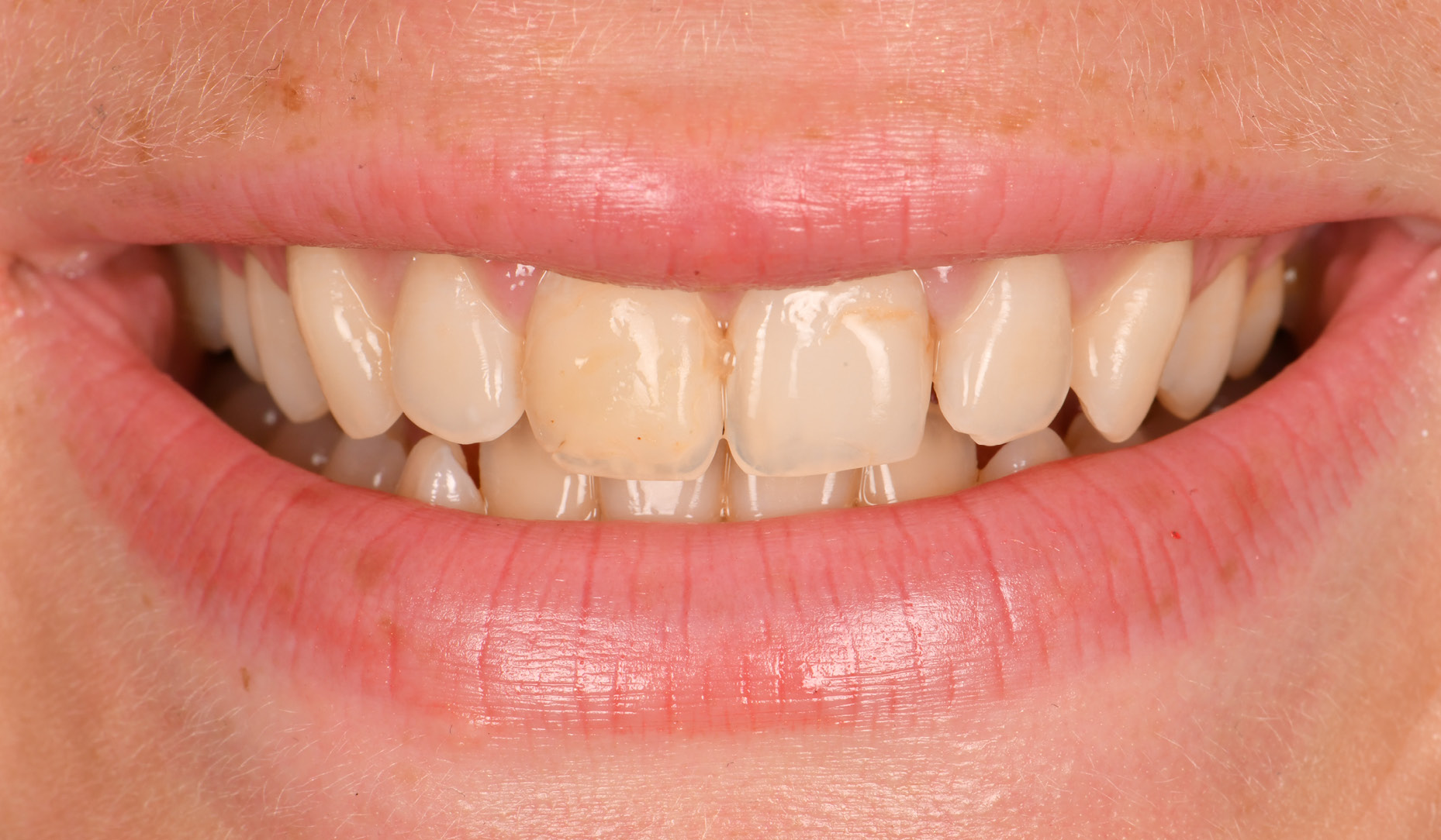 Simplifying Esthetic Composite Reconstructions Using CLEARFIL Majesty ...